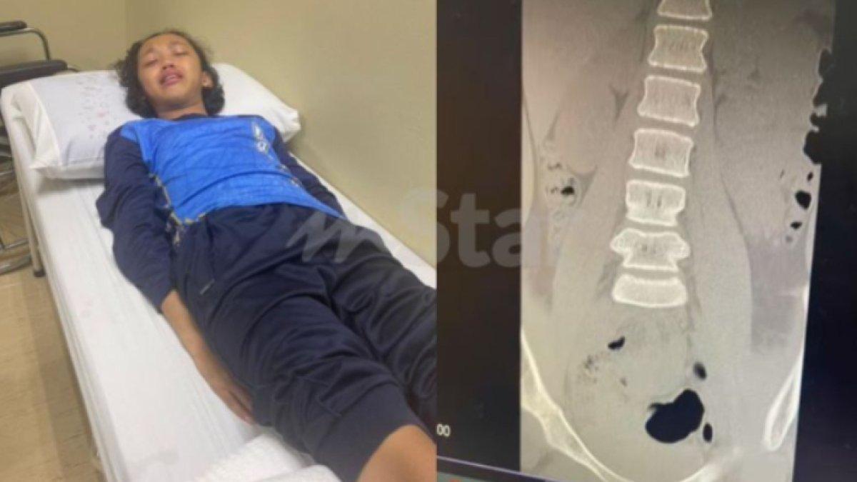 PILU Bocah Patah Tulang Belakang Gegara Dikerjai Teman di Sekolah, Kursi Ditarik saat Mau Duduk ...