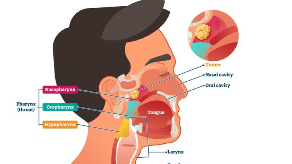 Berawal dari Pilek 2 Bulan, Pria Divonis Idap Kanker Nasofaring, Sesali ...