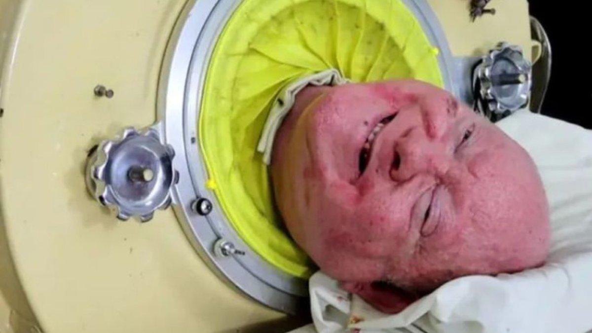 Sosok Paul Alexander, Manusia yang Hidup di Paru-paru Besi, Kini ...