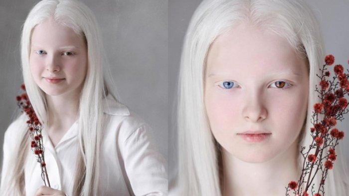 APA yang Membuat Paras Gadis Albino Amina Ependieva Ini Viral? Fokus ...