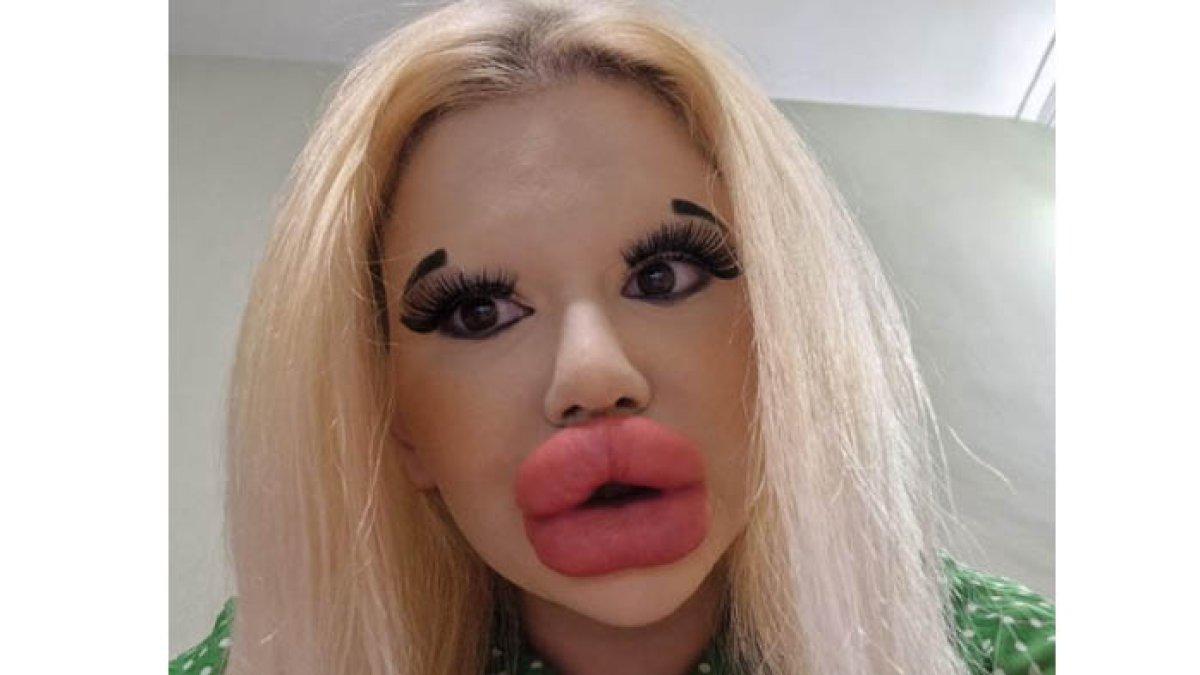 'Mau Kaya Boneka!' Wanita Permak Bibir Jadi Besar & Ingin Pipi Jumbo ...