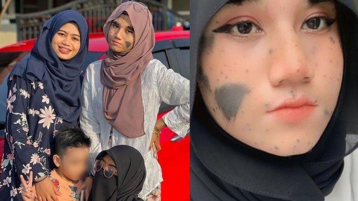 VIRAL Nasib Gadis Wajahnya Cantik Tapi Penuh Tanda Lahir, Percaya Diri ...