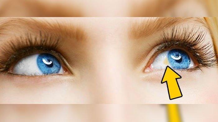 12 Tanda Kamu Idap Penyakit Serius, Dilihat dari Bola Mata: Hati-hati ...