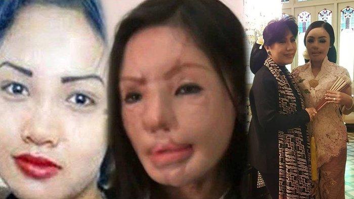 Ingat Lisa Wajahnya Disiram Air Keras Suami? Kini Makin Cantik ...