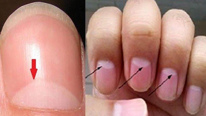 13 Tanda Perubahan Bagian Putih di Kuku, Ternyata Tunjukkan Kondisi Kesehatan, Jangan Sepelekan ...