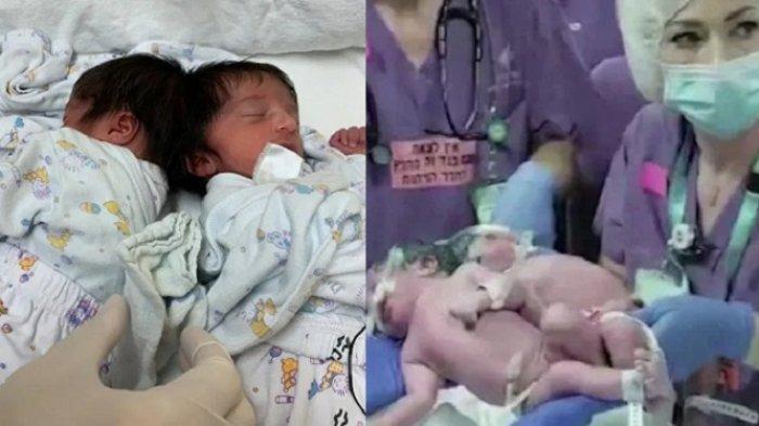 VIRAL Transformasi Bayi Kembar Siam Dempet Kepala, Kini Berhasil Dipisahkan, Foto Terbaru Buat ...