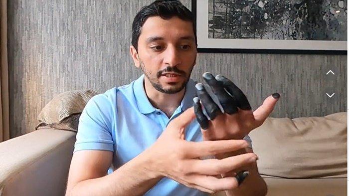 Apa Itu Frostbite? Paparan Suhu Dingin Berlebih, Biasa Dialami Pendaki ...