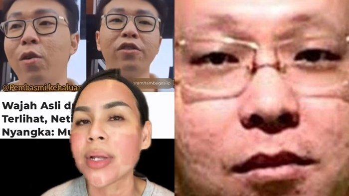 Dibela Melaney Ricardo, Wajah Bopeng Richard Lee yang Tak Sesuai ...