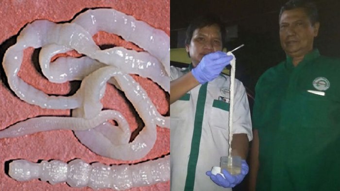 Cacing Pita 10,5 Meter Hidup Dalam Perut Seorang Warga, Penyebabnya Karena Makan Ini - Sripoku.com
