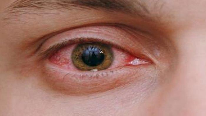 Fakta Baru Gejala Terinfeksi Covid-19 Terlihat Warna Merah Pada Mata ...