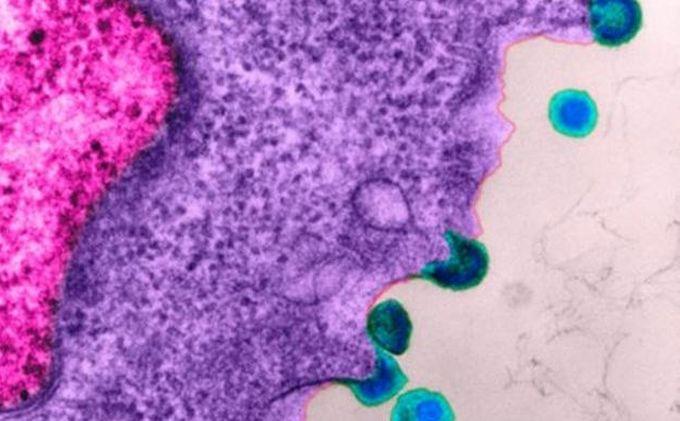 Darimana Asal Usul AIDS: Orang Pertama Terinfeksi HIV Rupanya Tentara ...