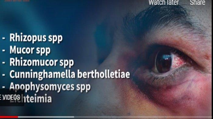 Waspada Penyakit Jamur Hitam, Kenali Gejala dan Penyebab, Serta Cara ...
