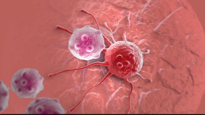 Apa Itu Limfoma? Kenali Gejala Awal Terjadi, Penyebab dan Berikut Cara ...