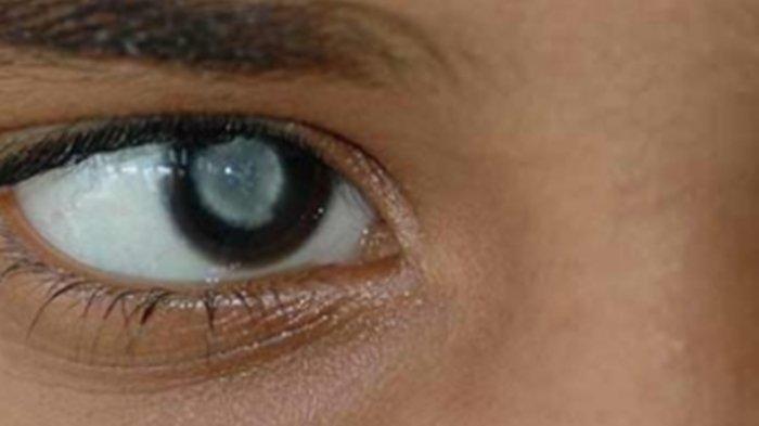 Penyakit Glaukoma Dapat Menyebabkan Buta Permanen, Ini Gejala Awalnya ...