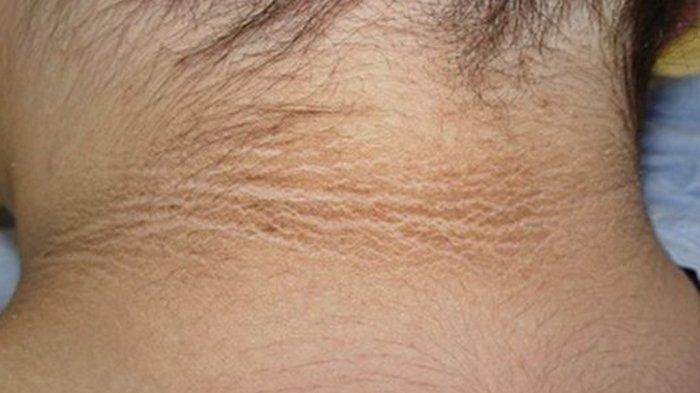 Ini Cara Mengatasi Lipatan Hitam di Leher Yang Bikin Tak Percaya Diri ...