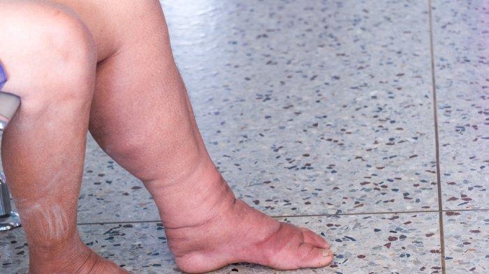 FAKTA Penyakit Kaki Gajah, Sebabkan Cacat Permanen Meski Parasit Sudah ...