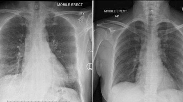 Tak Hanya Gejala, Ini Perbedaan Foto Rontgen Paru-paru Pasien Covid-19 ...