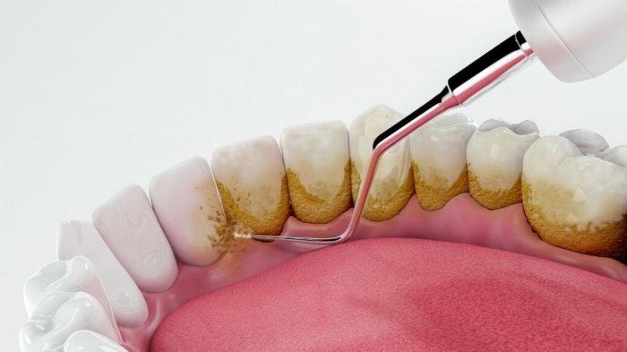 Scaling Gigi, Pentingnya Perawatan Gigi dan Kesehatan Mulut, Ini Manfaatnya - Tribun-pantura.com