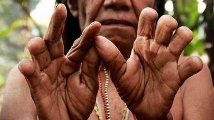 POTONG JARI ala Suku Dani Papua, Mirip Tradisi Yakuza Jepang - Tribun ...
