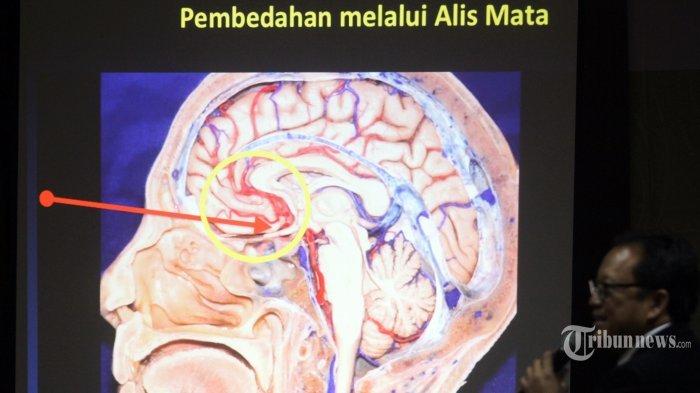 Waspada, Adanya Tumor Ganas pada Ovarium, Ini Penjelasan Dokter - Tribun-papua.com