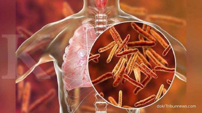 Tidak Semua Orang Terinfeksi Kuman TBC Mengalami Gejala Sakit - Tribun ...
