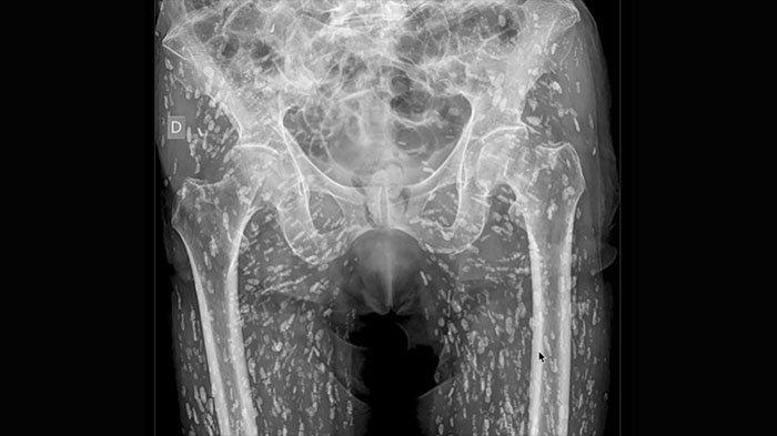 Ke RS Setelah Terjatuh Pria Ini Malah Syok Lihat Foto Rontgen, Makhluk ...