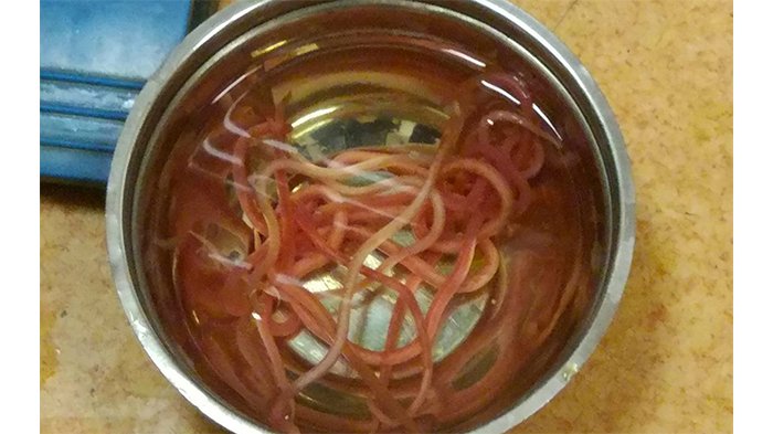 Tanda-tanda Anak Cacingan, dari Berat Badan Serta Kemerahan di Kulit ...