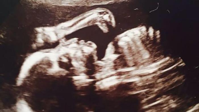 Hasil Scan Kehamilan Wanita Ini Ada Penampakan Mirip Dinosaurus ...