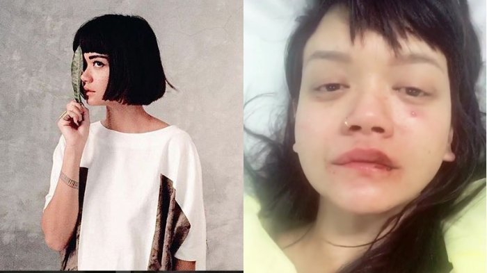 Viral, Dylan Sada Model Indonesia di AS Babak Belur Dihajar Pacarnya ...