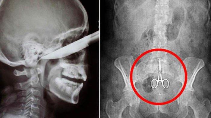 Sakit Bertahun-tahun, Alangkah Kagetnya Ibu Ini Saat Rontgen Perut ...