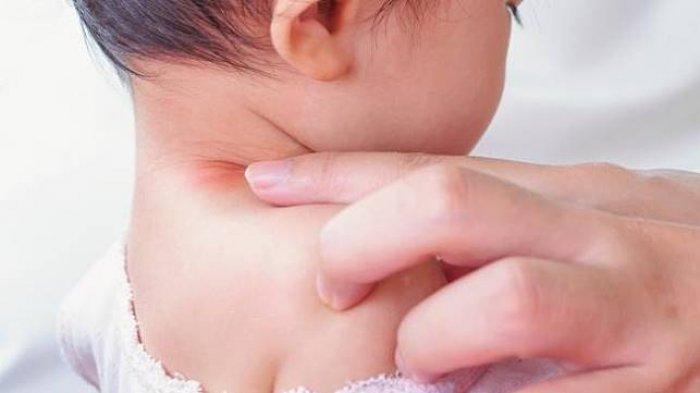 Kenali Tanda-tanda Alergi Pada Anak dan Bedanya dari Infeksi ...