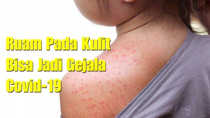Video: Hati-hati! Ruam Pada Kulit Bisa Jadi Gejala dari Covid-19, Ini ...