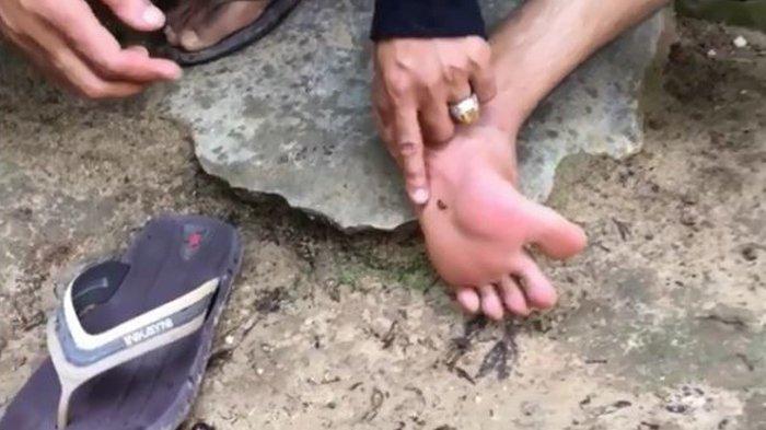 USTADZ Abdul Somad Digigit Pacat di Telapak Kaki, Ini Potret UAS ...