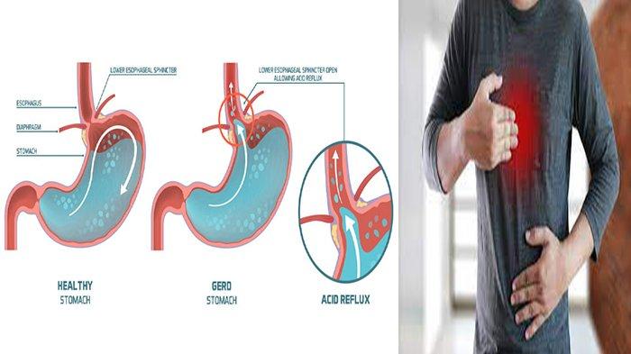Ternyata Ini Perbedaan Maag dan GERD, Hingga 3 Metode Mengobati Asam ...
