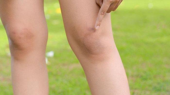 SOLUSI Mencerahkan Siku dan Lutut yang Menghitam dengan 9 Cara Ini ...