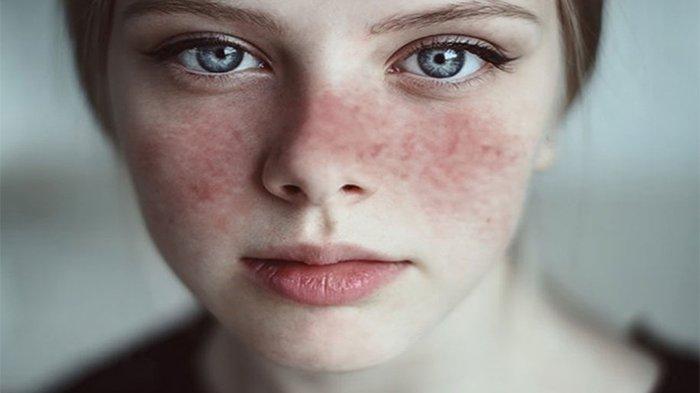 Inilah Arti Multiple Sclerosis, Kondisi Buruk yang Sering Terjadi Pada ...