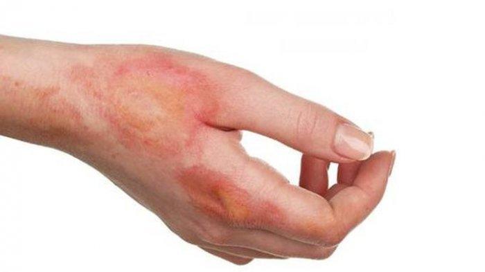 Cara Mengatasi Kulit Terkena Minyak Panas dan Pertolongan Pertama Luka ...