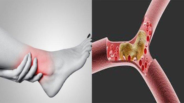 Cukup Oleskan Bahan Dapur Ini Selama 15 Menit, Asam Urat Langsung ...