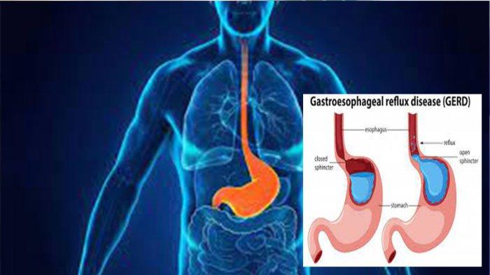 Gejala Gerd Parah Waspadai agar Tak Fatal, Berikut Tanda-tandanya dan ...
