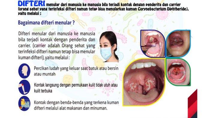 Dua Warga Singkawang Meninggal Dunia Akibat Difteri, Ketahui Gejala dan ...