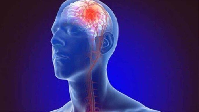Sifat Penyakit Stroke yang Harus Diketahui ! Kenali Gejala Stroke ... Sifat Penyakit Stroke yang Harus Diketahui ! Kenali Gejala Stroke ...