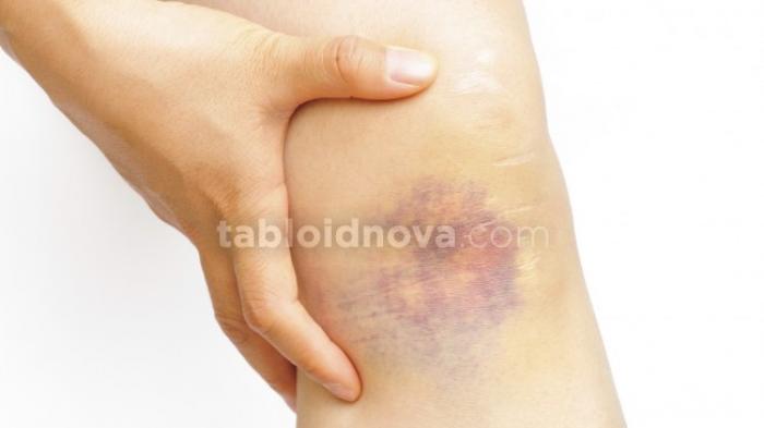 Inilah Penyebab Muncul Memar Tiba-tiba di Bagian Tubuh ...