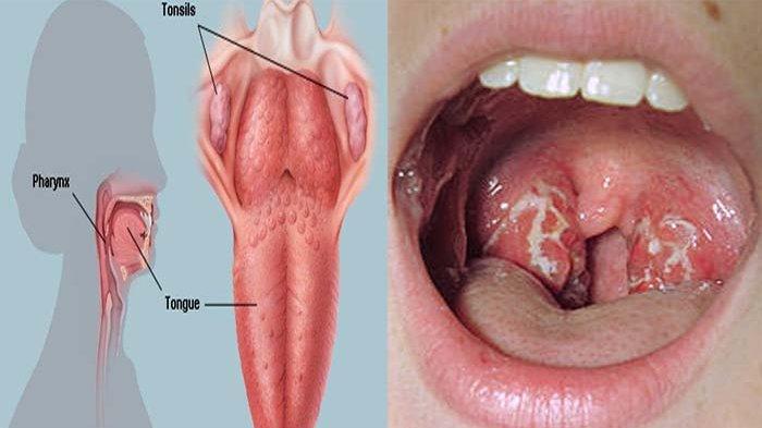 KENALI GEJALA Penyakit Tonsilitis, Cara Alami Sembuhkan Radang Amandel atau Tonsilitis ...