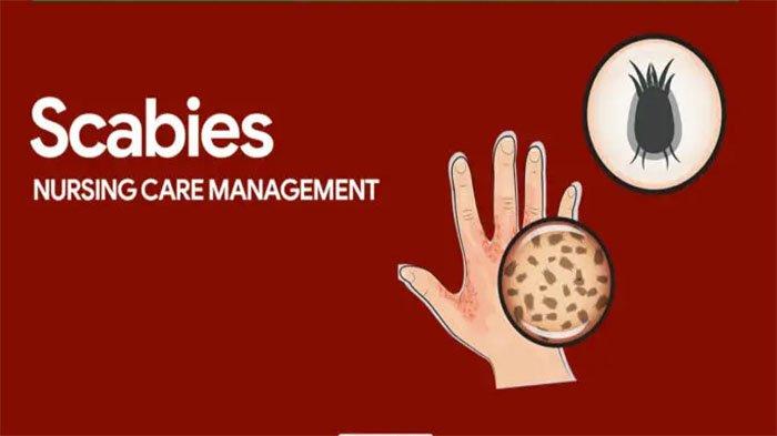 SCABIES Penyakit Menular Hebohkan Warga Kota Pontianak! Kenali Gejala ...