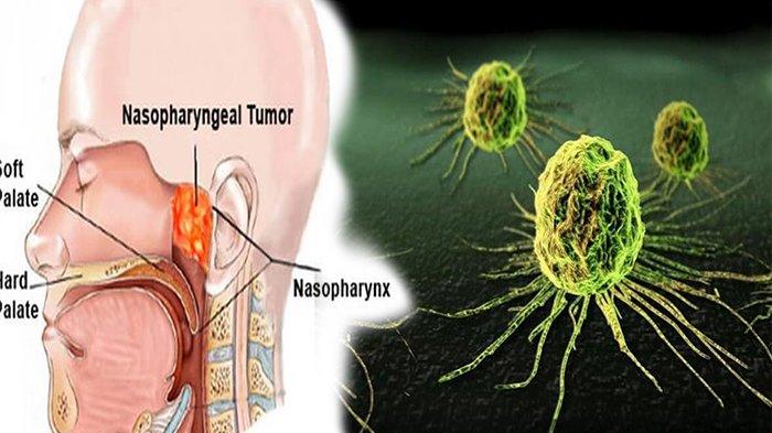 KENALI KANKER Nasofaring Stadium 4, Gejala Kanker Ini Pembengkakan di ...