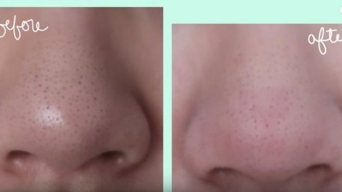 Cara Ampuh Usir Komedo, Begini Tips Ahli Kecantikan Korea ...