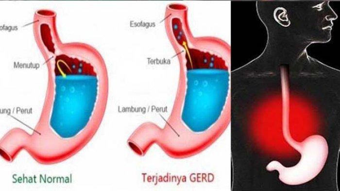 Gejala GERD atau Asam Lambung Yang Perlu Penanganan Lama Bahkan Bisa ...