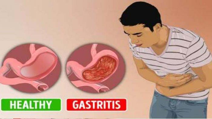 Cara Menyembuhkan Gerd Paling Ampuh, Pakai Obat Alami dan Pola Hidup ...