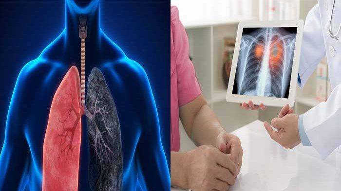 Gejala Bronkitis yang Sering Diabaikan, Kenali Penyakit Infeksi Paru ...