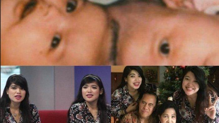 Masih Ingat Kembar Siam Dempet Kepala Pertama di Indonesia yang ...